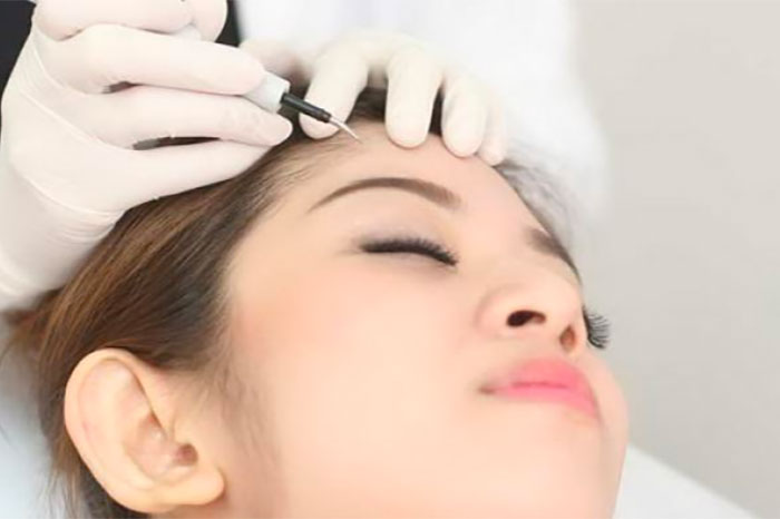 Coba Treatment Cauter, Hilangkan Kutil dan Milia – Yugen Clinic